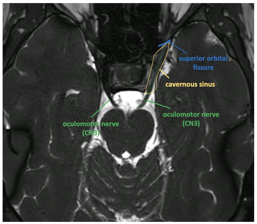 A reminder to all #radres on their first #neurorad rotation: in the # ...