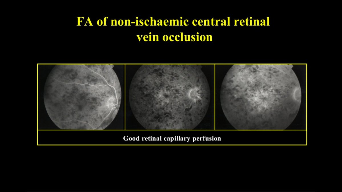 Ischemic Central Retinal Vein Occlusion