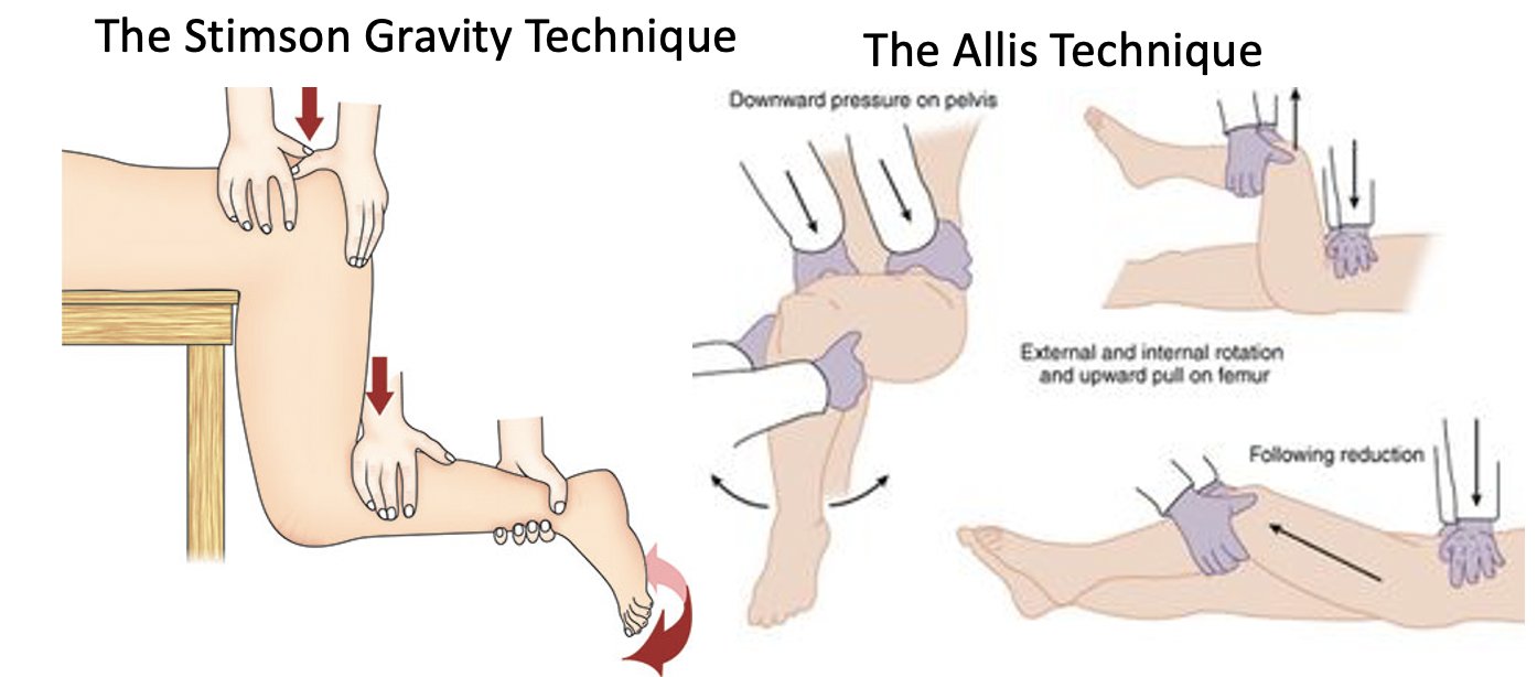 Allis Technique