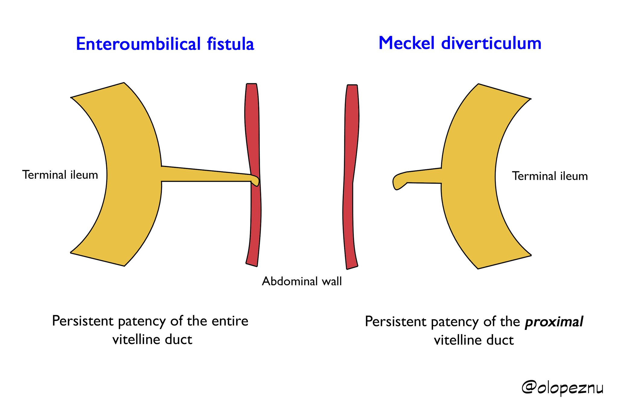 Omphalomesenteric Duct Remnant And Meckel's Meckel’s Diverticulum