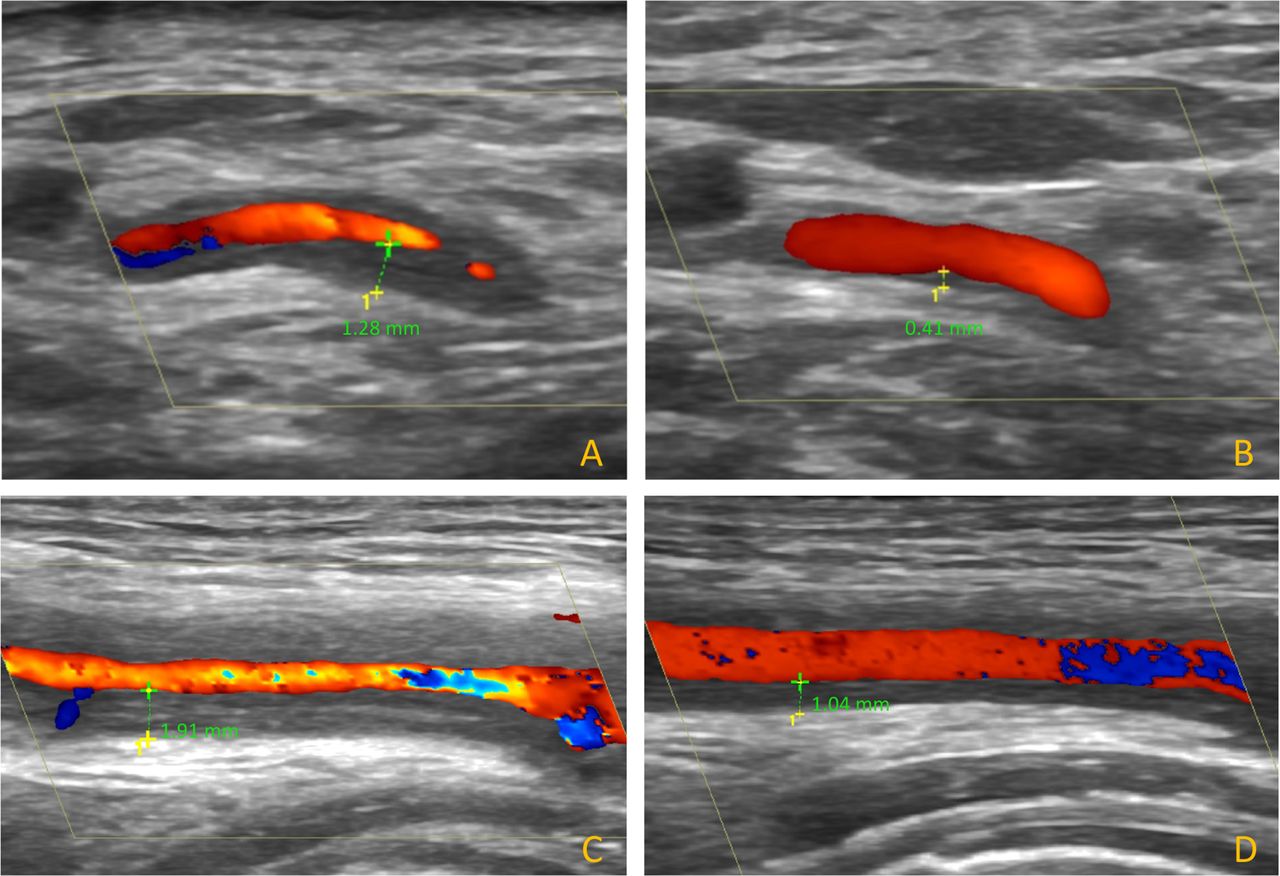 Temporal Artery Ultrasound