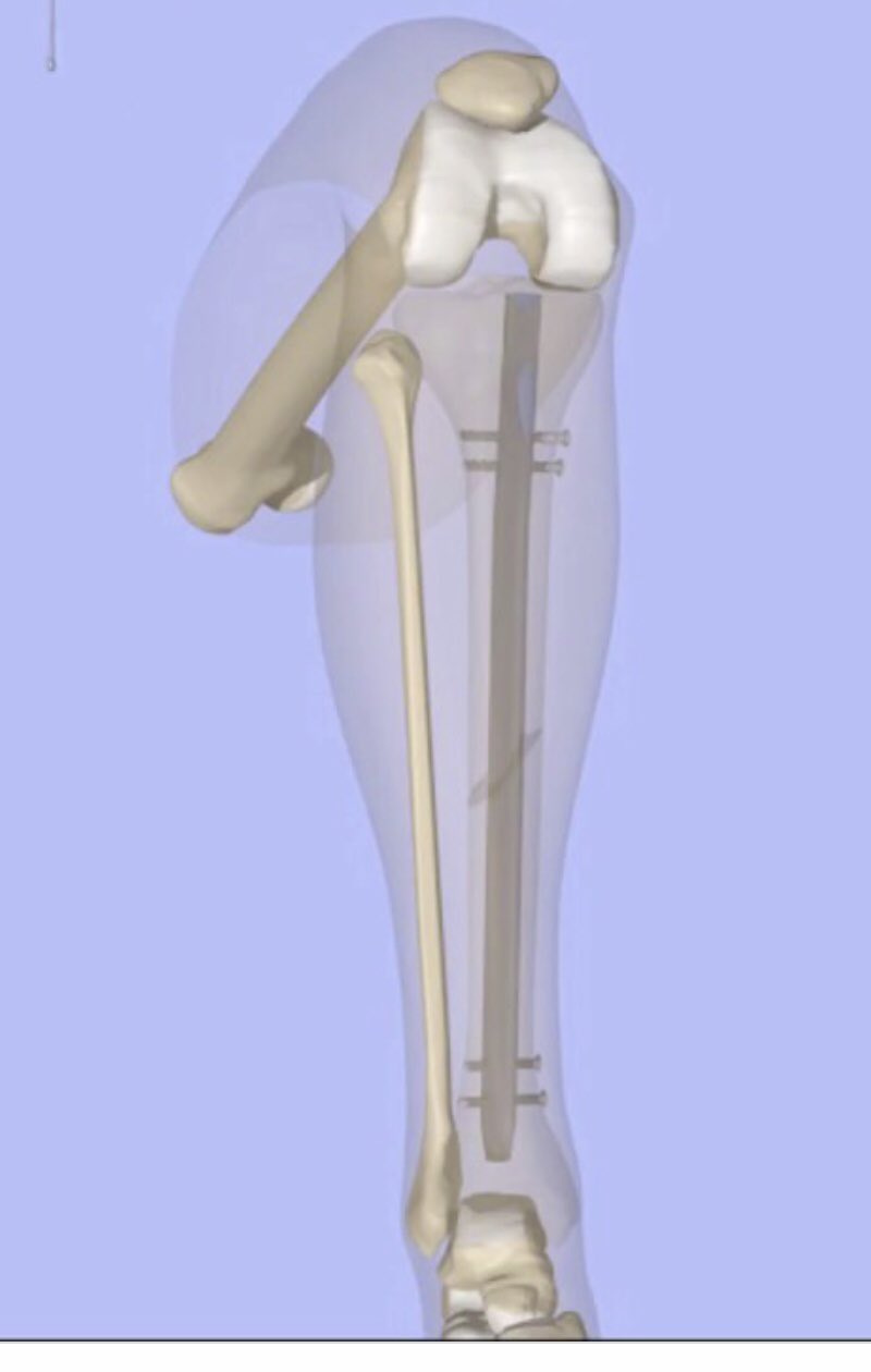 Intramedullary Rod Tibia