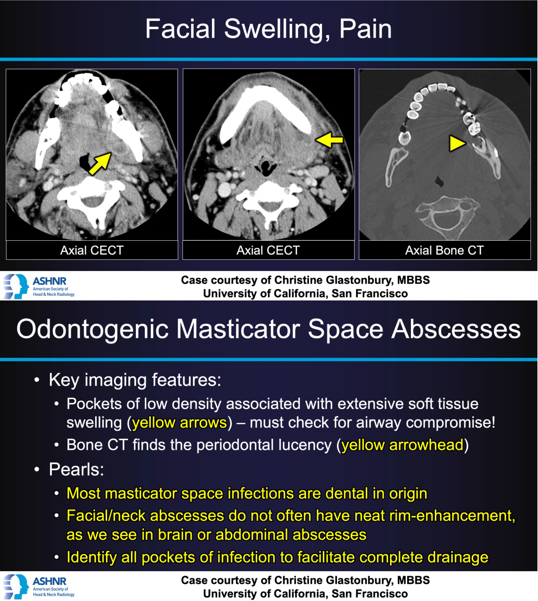 Masticator Space Infection