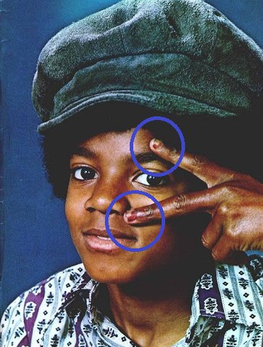 Vitiligo Michael Jackson Proof