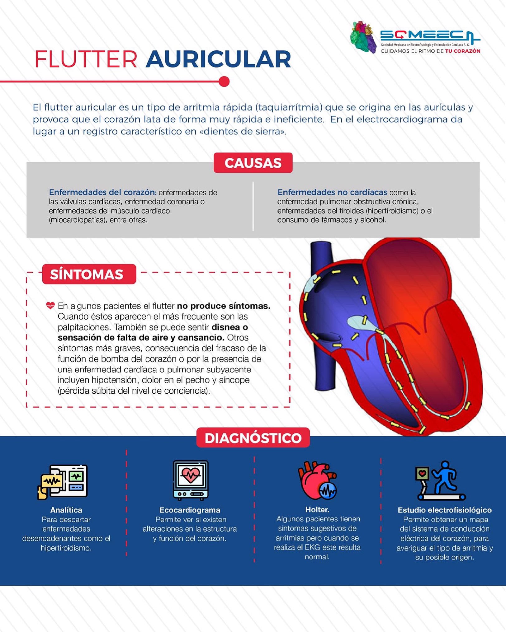 Abolido Celda de poder entrada arritmia flutter auricular banjo Patatas ...