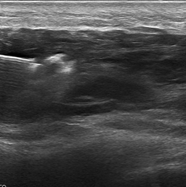 El seroma de Morel-Lavallée es una lesión relativamente frecuente de ...