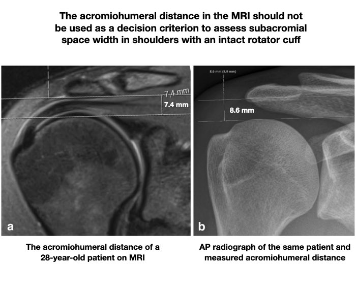 Shoulder Mri Without Contrast