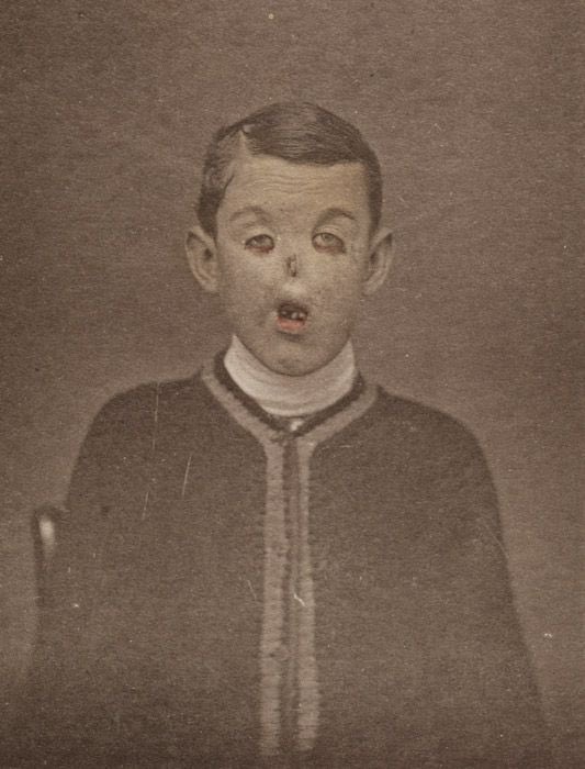 Congenital Syphilis Face