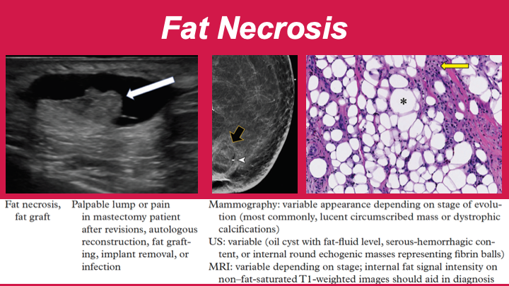 Necrotic Fat