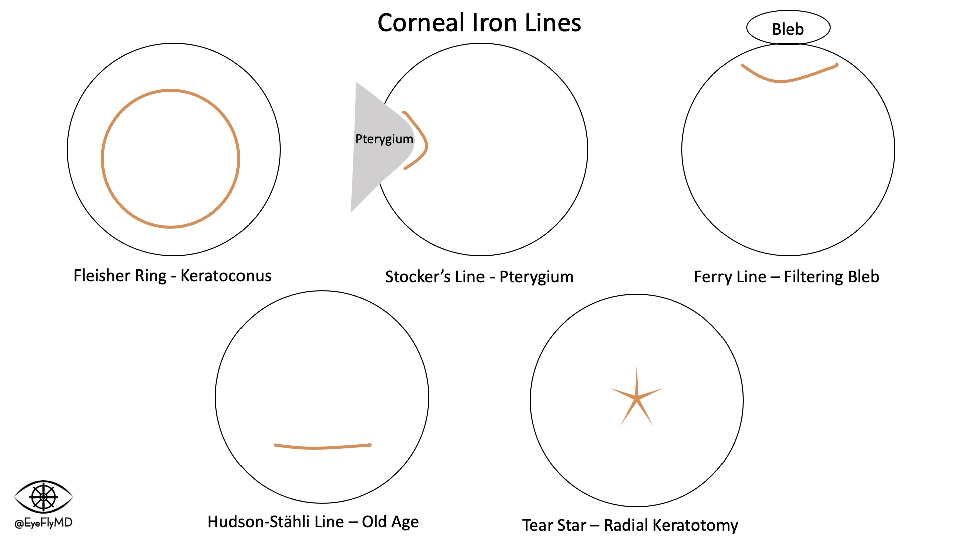 Cornea Iron Line On