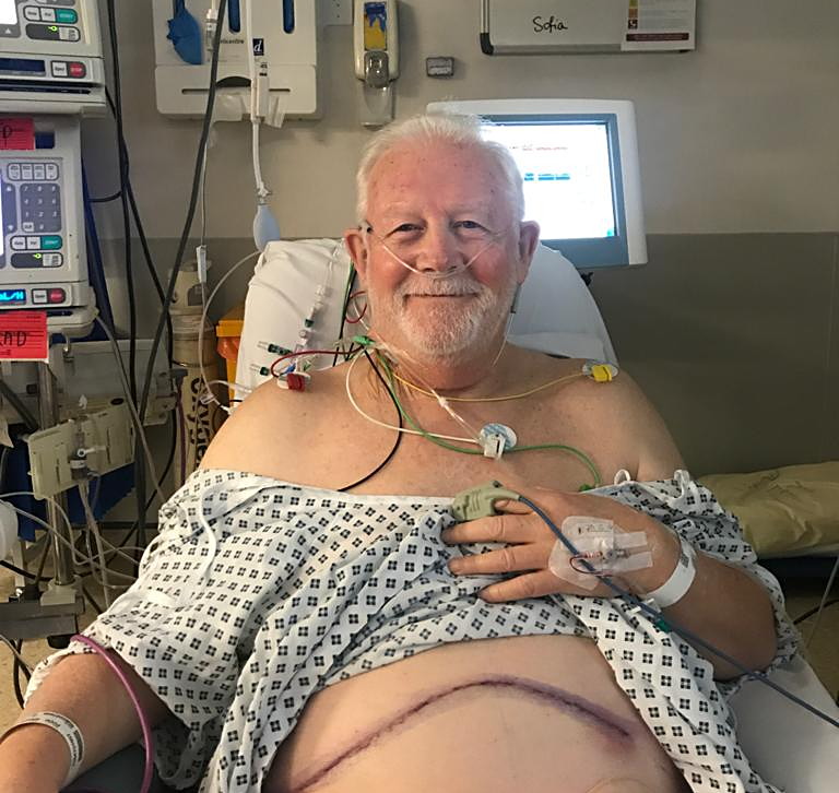 Whipple Procedure Scar