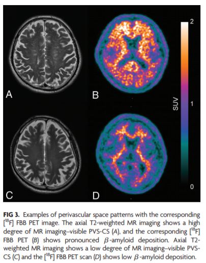 Centrum Semiovale Mri