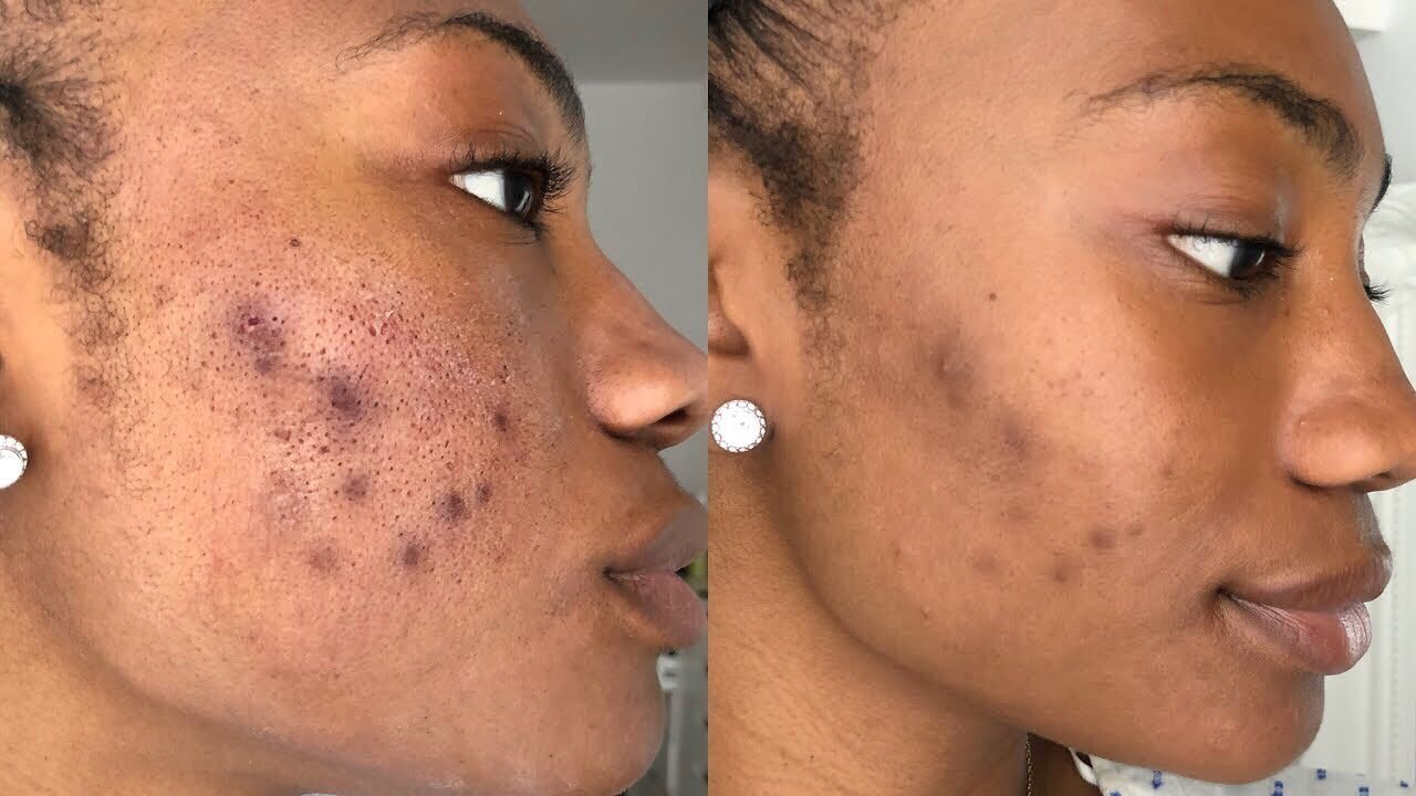 Pcos Before And After Acne