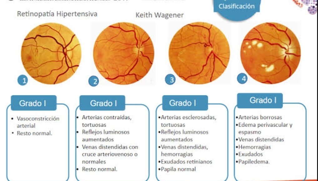Retinopatía Hipertensiva Grado 1
