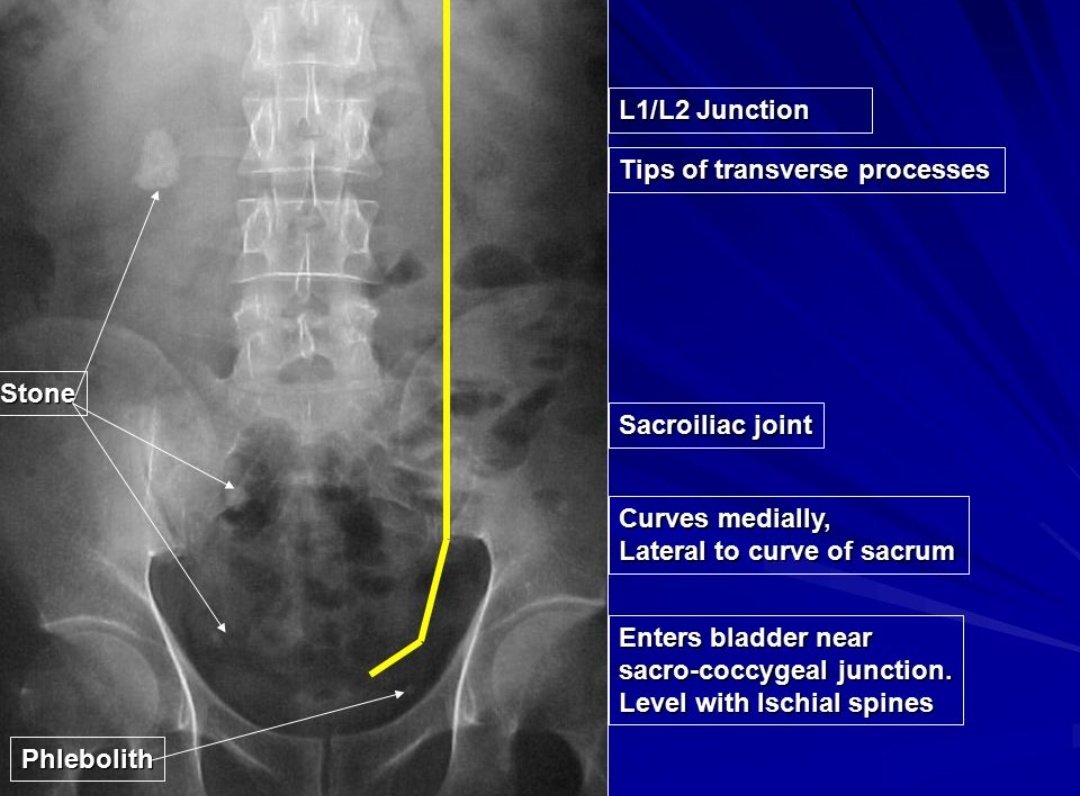 Calcification In The Veins