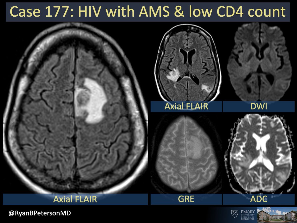 Emory Radiology COTD #177 Hx: HIV with altered mentation & low CD4 ...