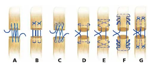 Rafflesia Arnoldi repetir montaje puntos de kessler Porra Por Estrecho