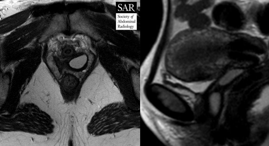 Bartholin Gland Cyst Mri