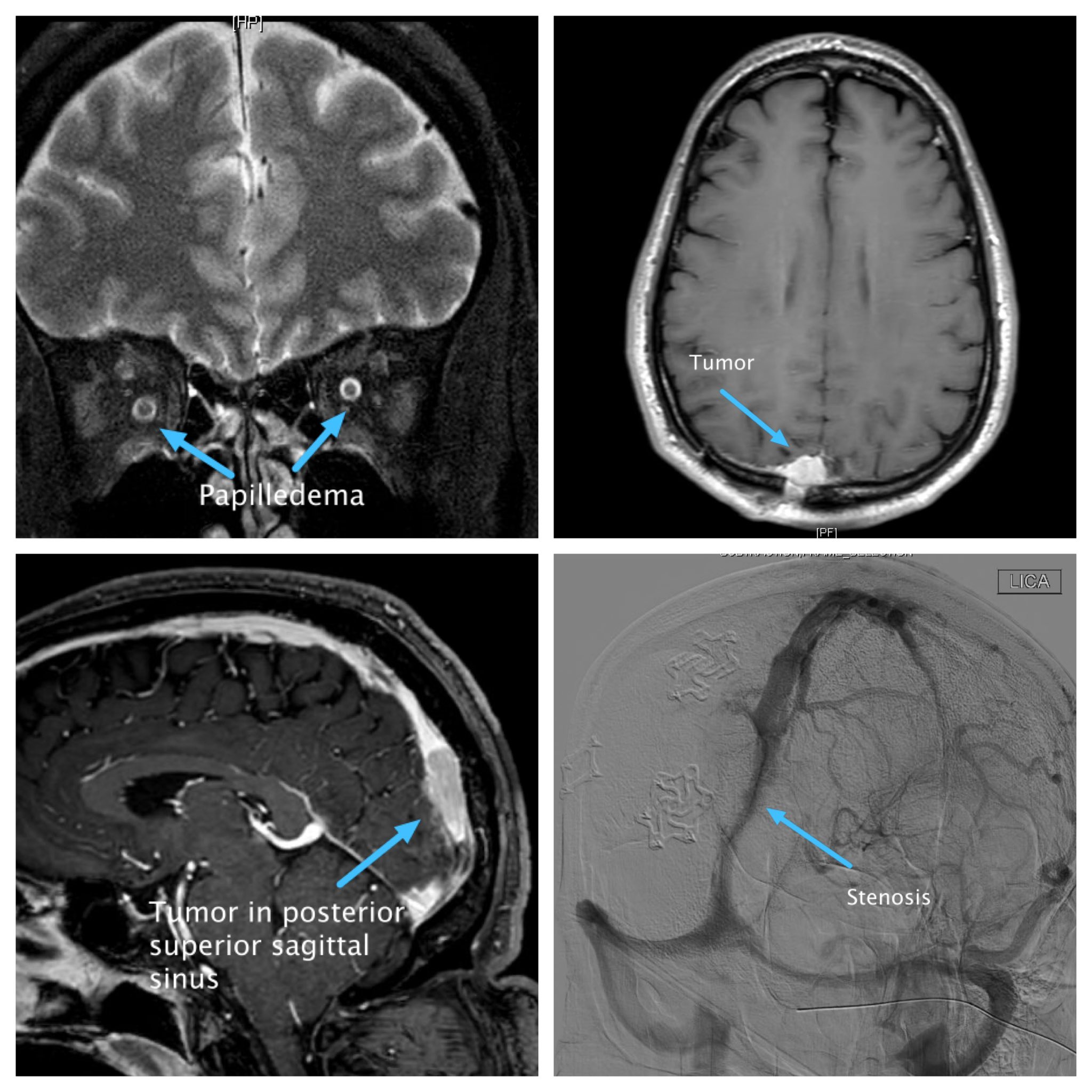 Superior Sagittal Sinus