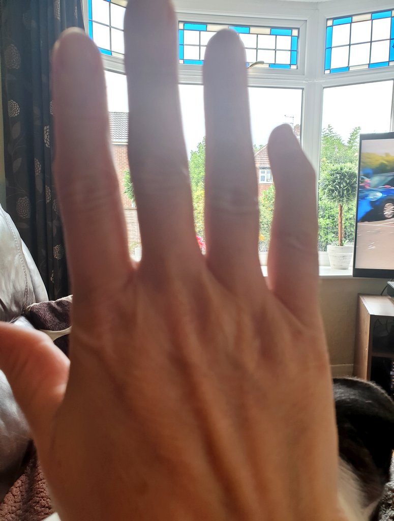 Broken Pinky Finger