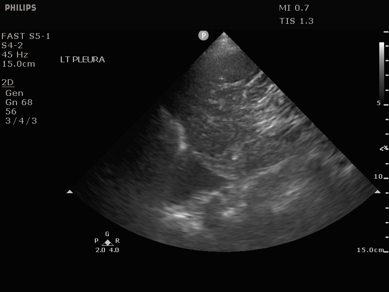 Costodiaphragmatic Angle