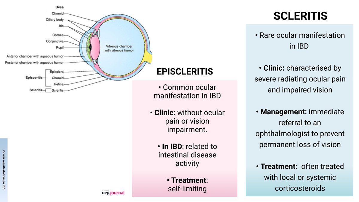 Episcleritis Vs Scleritis