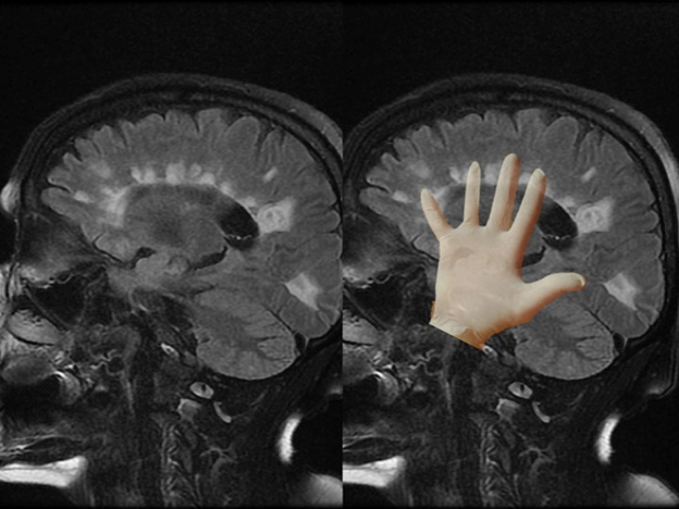Multiple Sclerosis Mri Dawsons Fingers