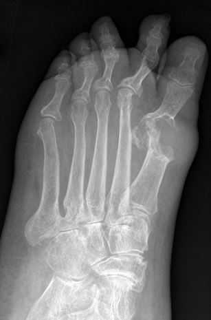 Gout Toe Xray