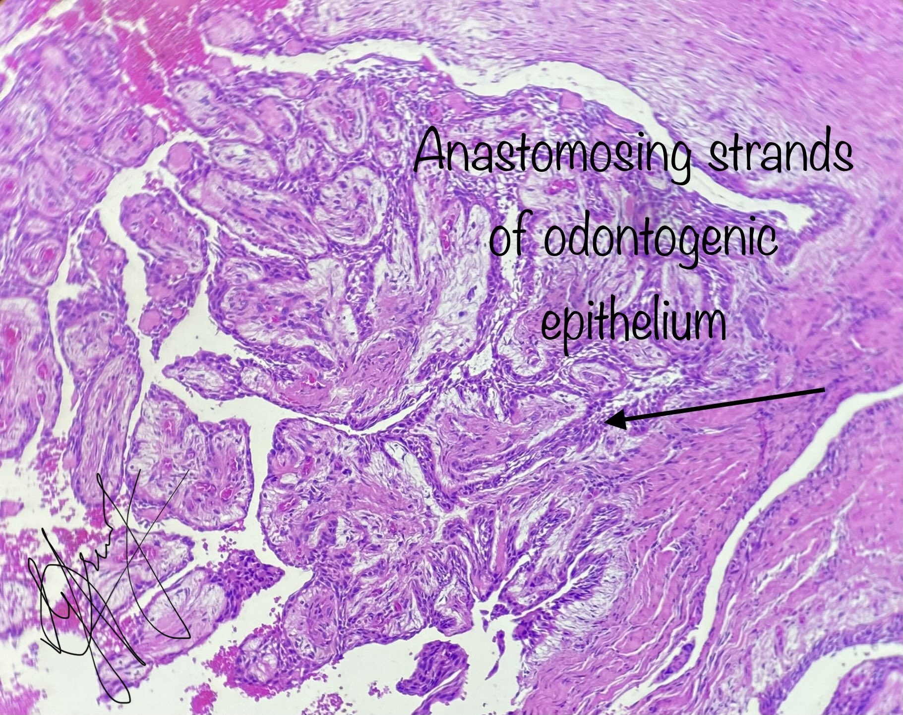 Plexiform Ameloblastoma Histology
