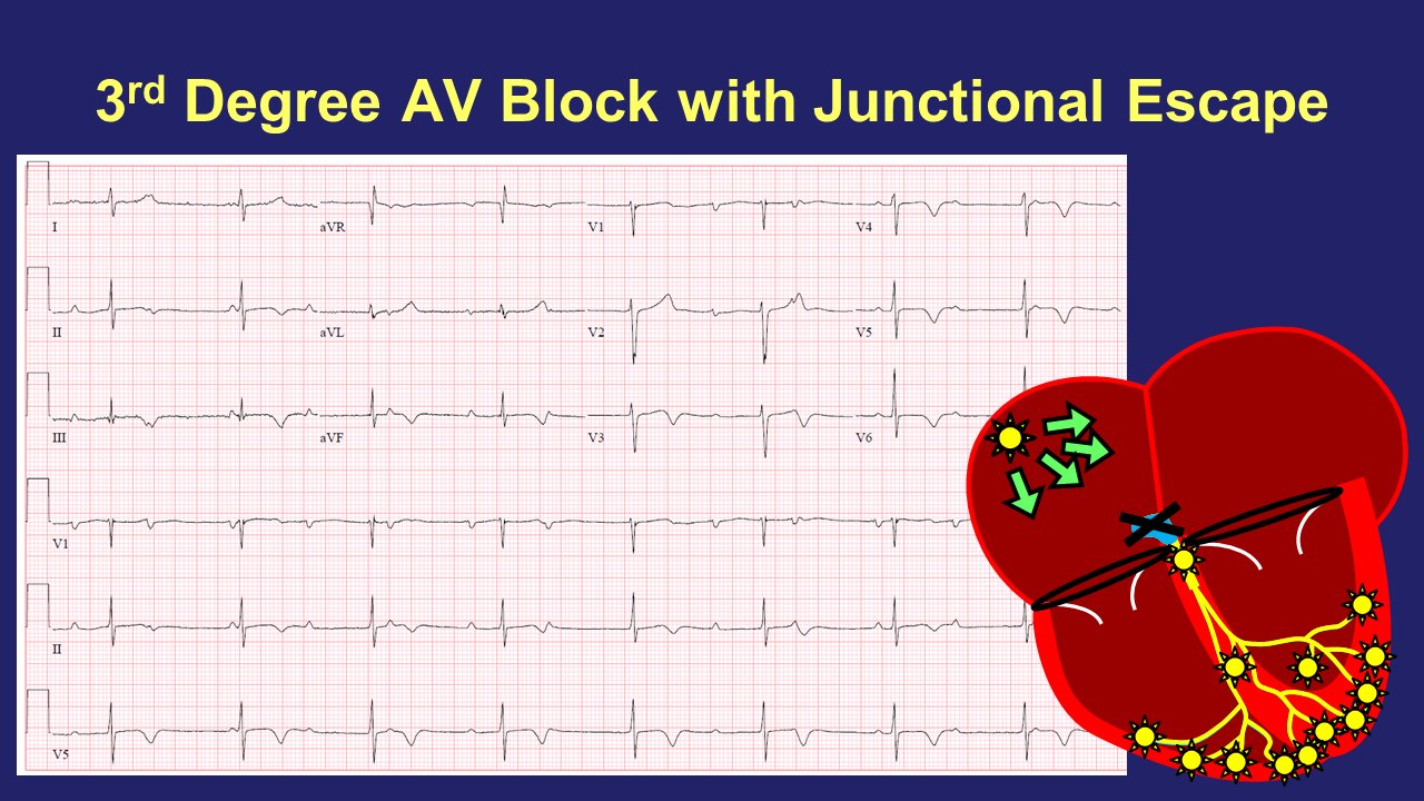Junctional Escape Rhythm
