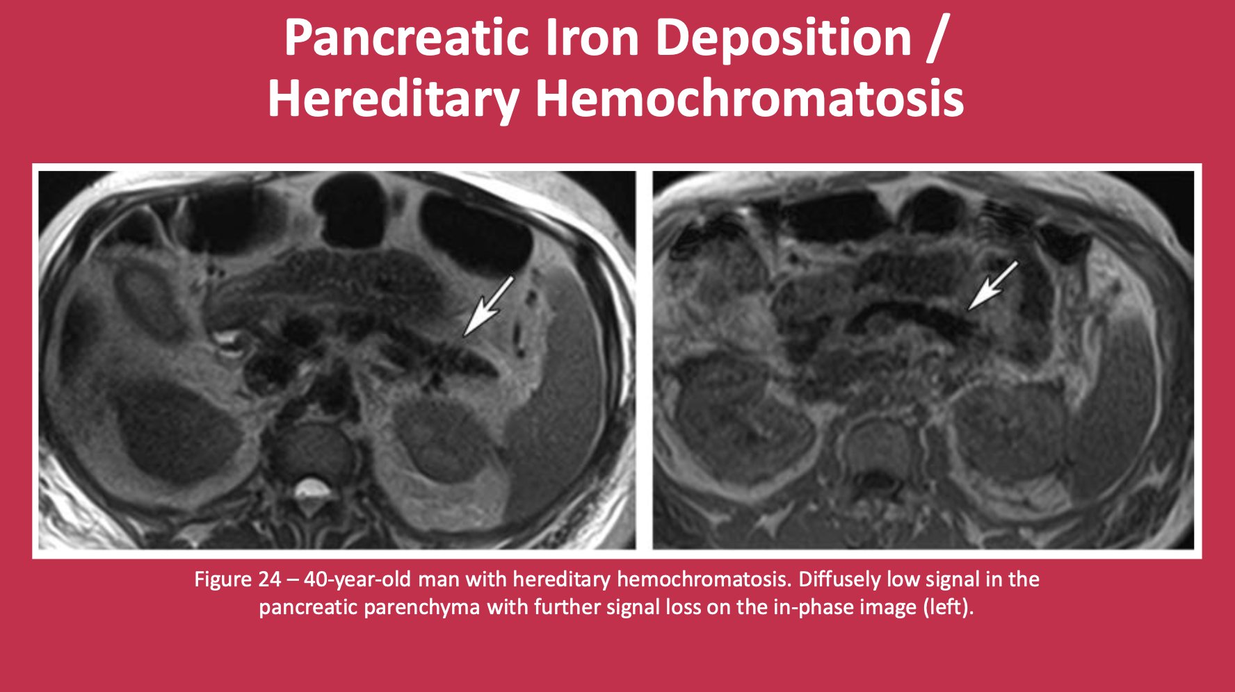 Hemochromatosis Pancreas