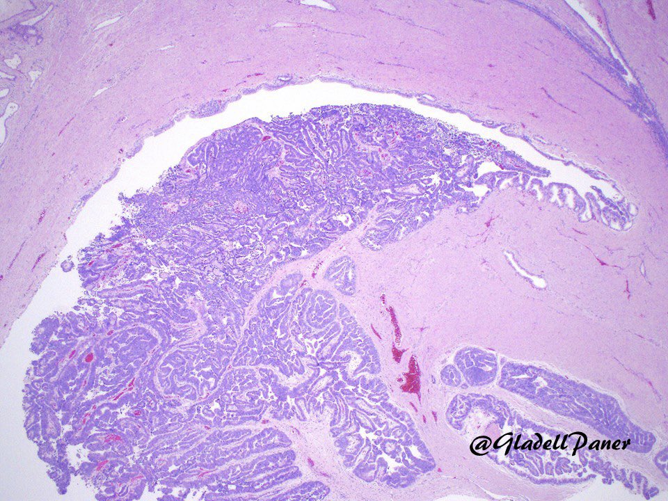 Prostatic Utricle Histology