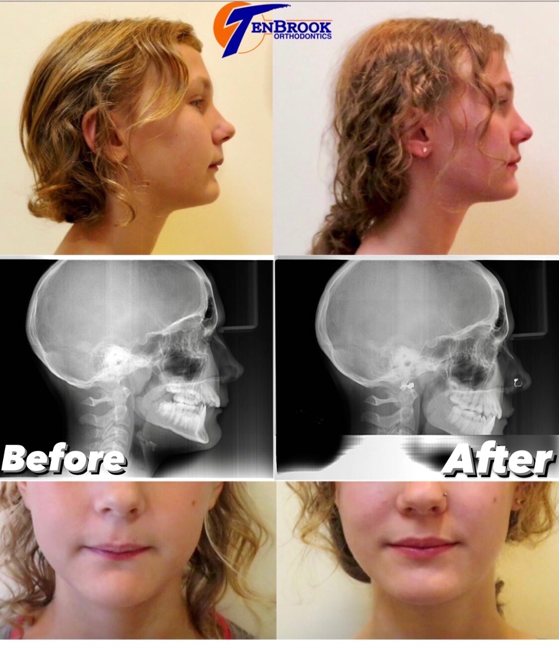 TenBrook Orthodontics on Twitter: "A child’s jaw & face grow very fast. Left unmonitored or ...