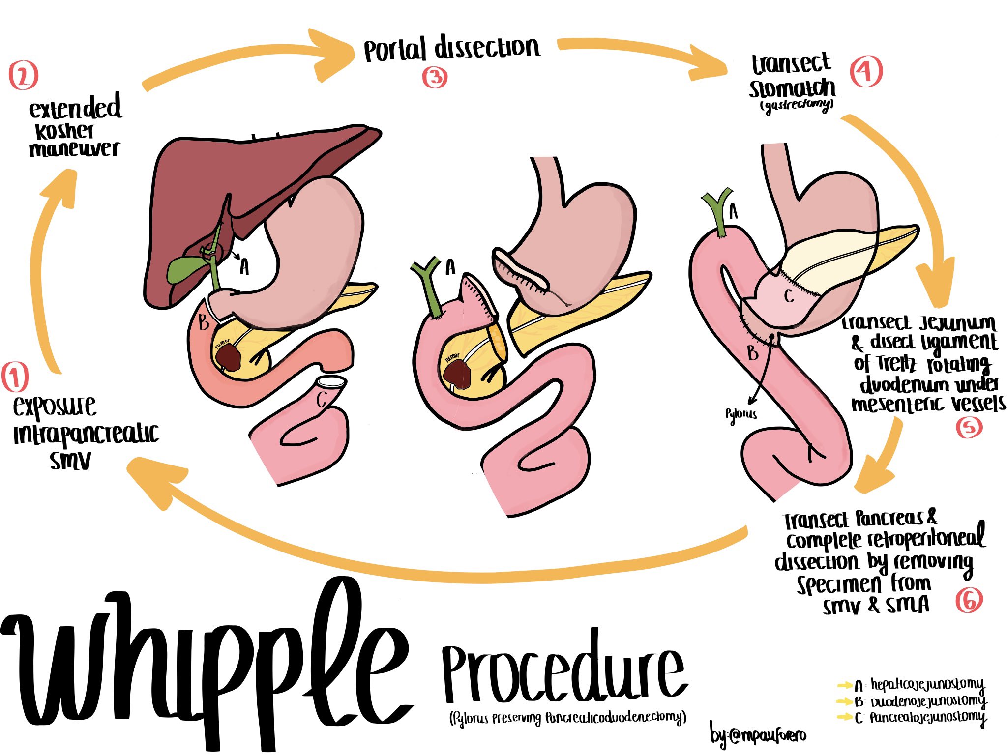 Pylorus Sparing Pancreaticoduodenectomy