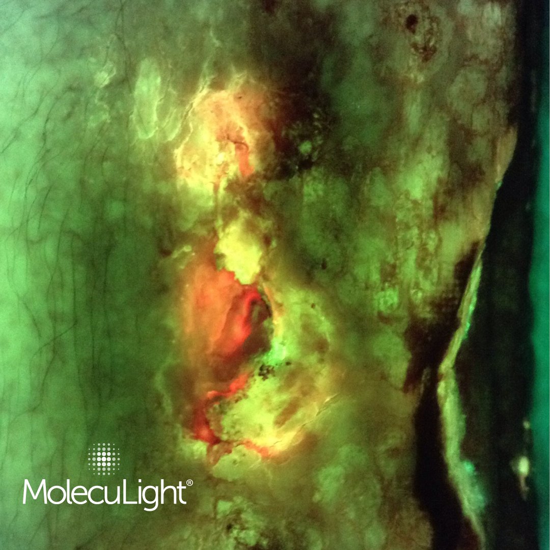 MolecuLight Inc | Advanced Wound Care Solutions
