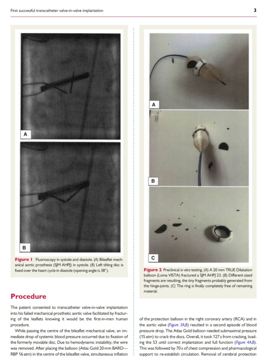 Wow...MIND BLOWN! Transcatheter Aortic Valve Implantation (TAVI) inside ...