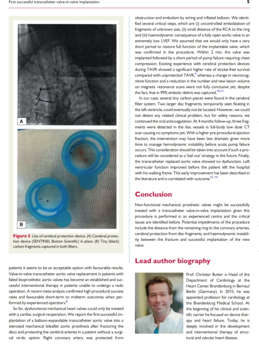 Wow...MIND BLOWN! Transcatheter Aortic Valve Implantation (TAVI) inside ...