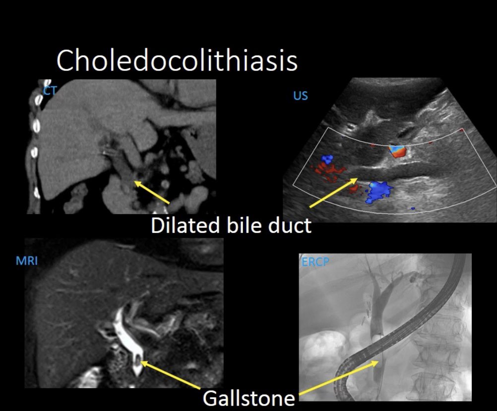 Choledocholithiasis Ercp