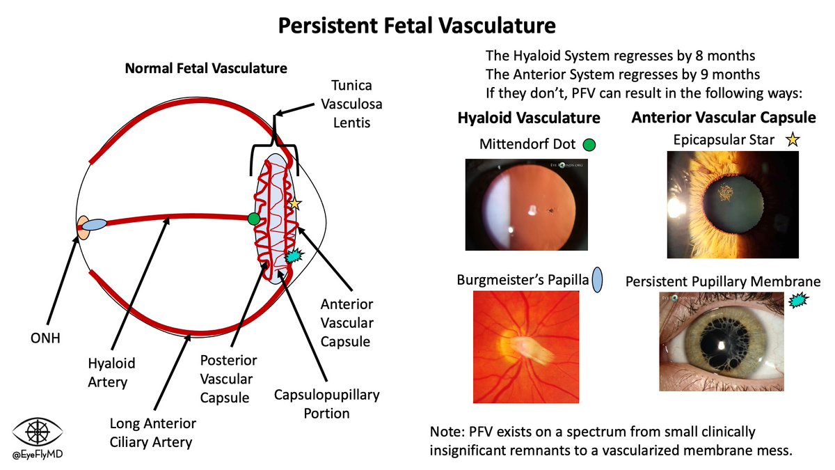 Anterior Persistent Fetal Vasculature