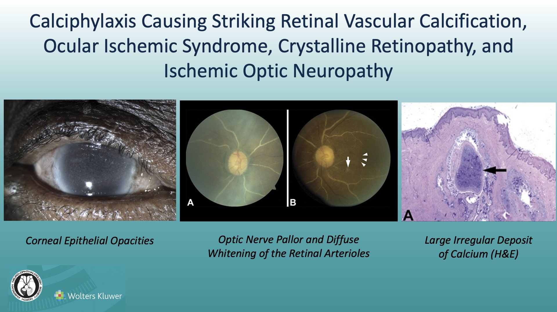 Crystalline Retinopathy