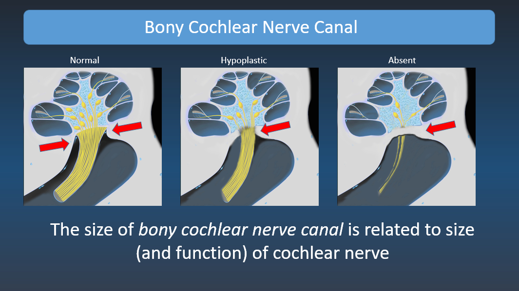 Cochlear Nerve