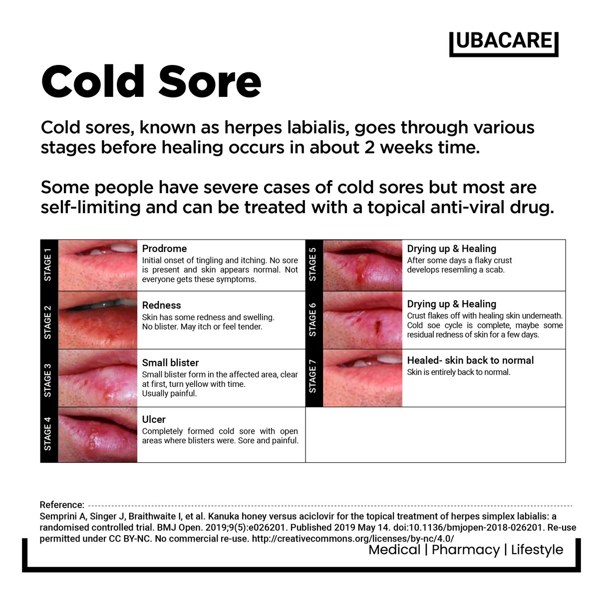 Cold Sore Stages Treatment