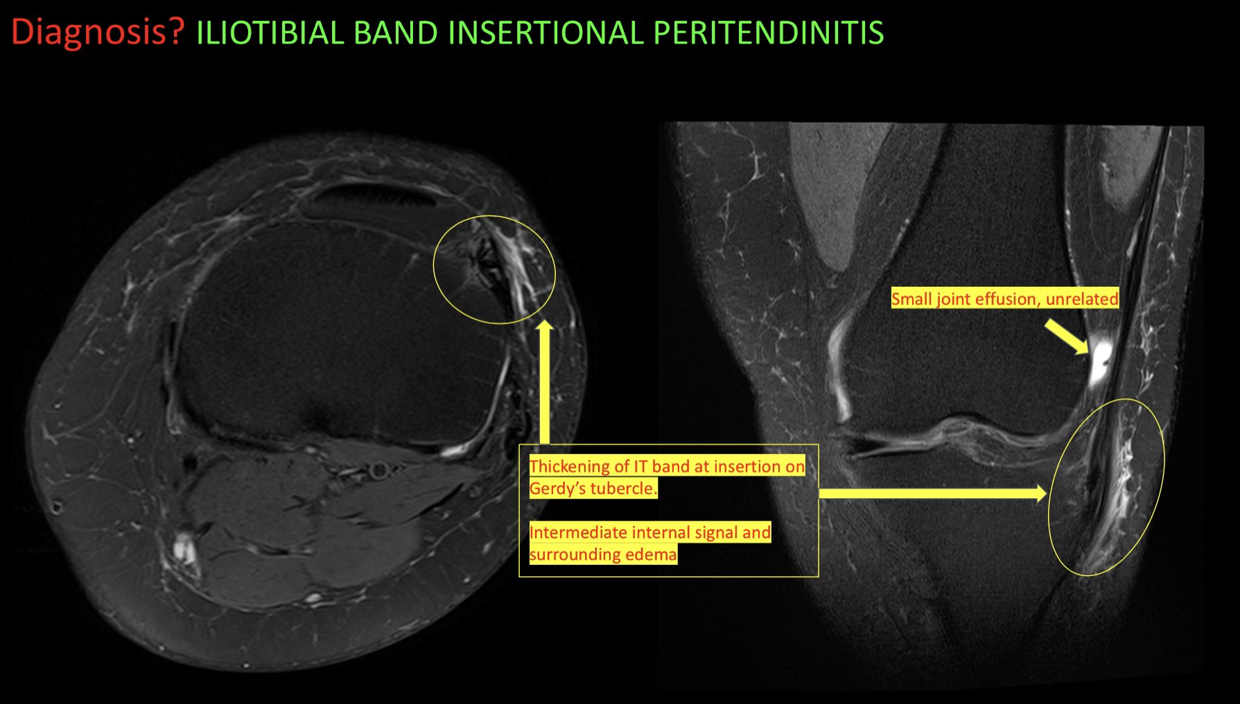 Iliotibial Band Mri Iliotibial Band Avulsion Fracture. A Frontal