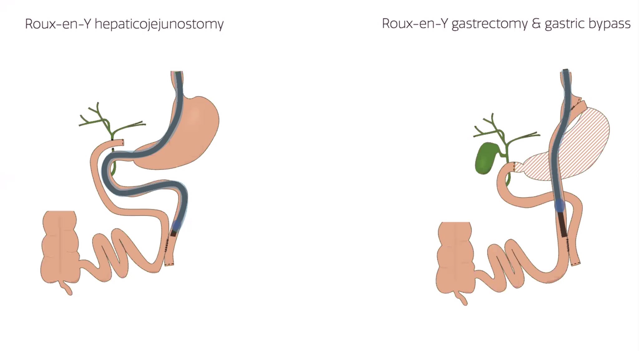 Roux En Y Hepaticojejunostomy