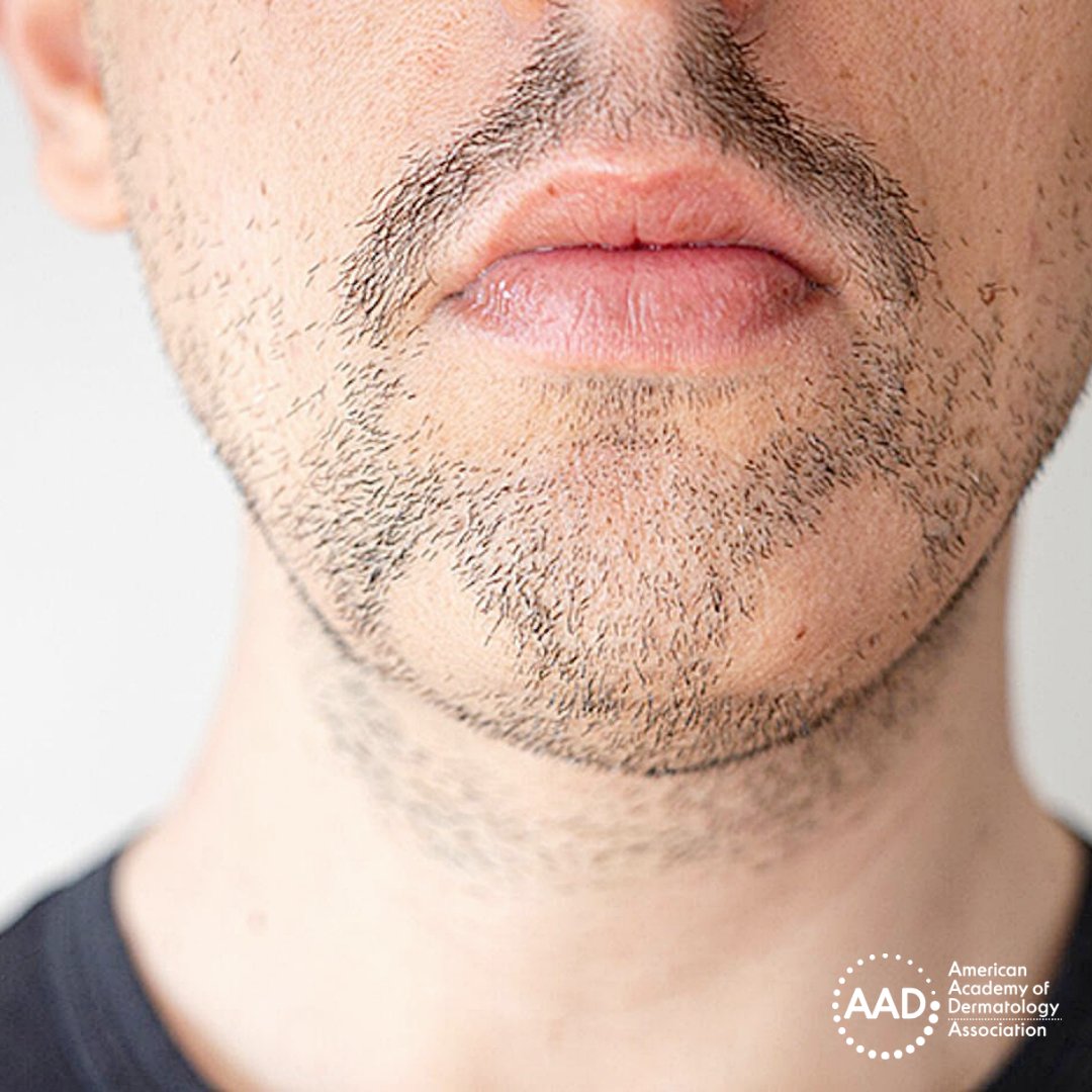 Alopecia Areata Beard