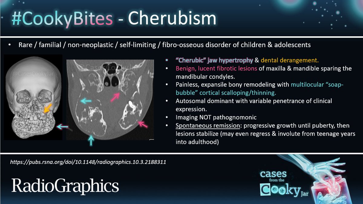 Cherubism Xray