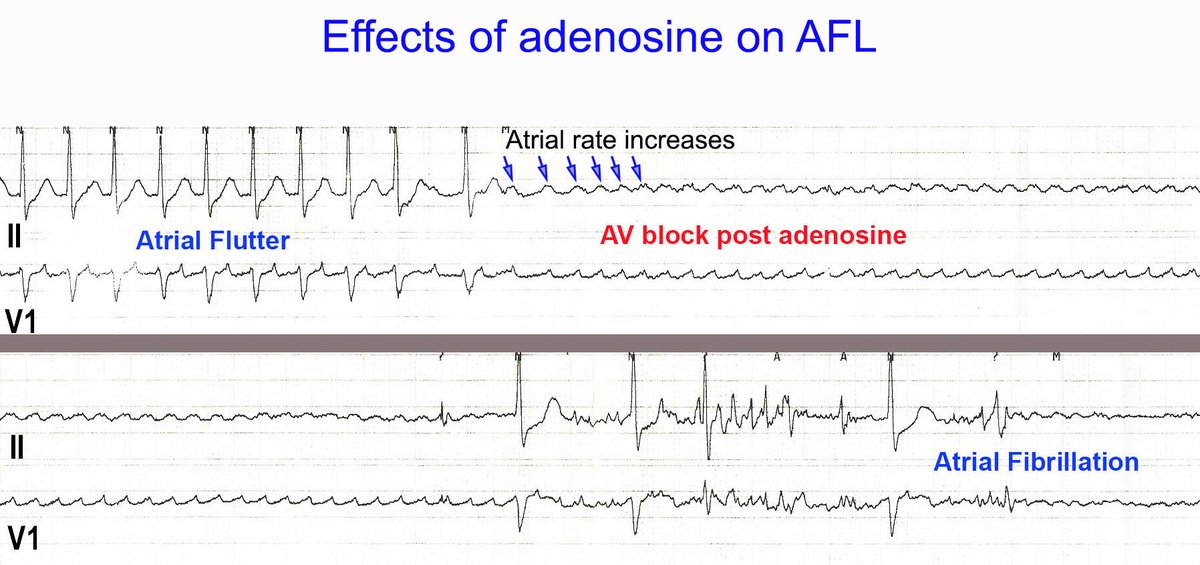 #IssaTweetorials How does drug therapy affect atrial flutter (AFL)? 1/8 ...