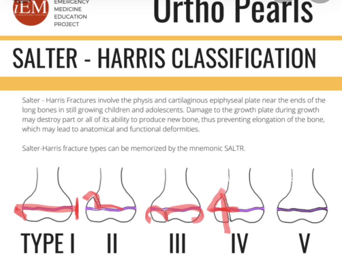Salter Harris Fractures Pediatric Physeal Fractures G - vrogue.co