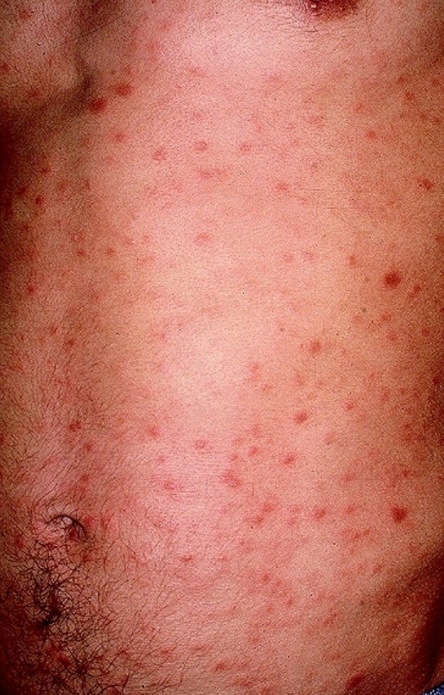 Roseola Sifilitica AEDV Expert Consensus For The Management Of