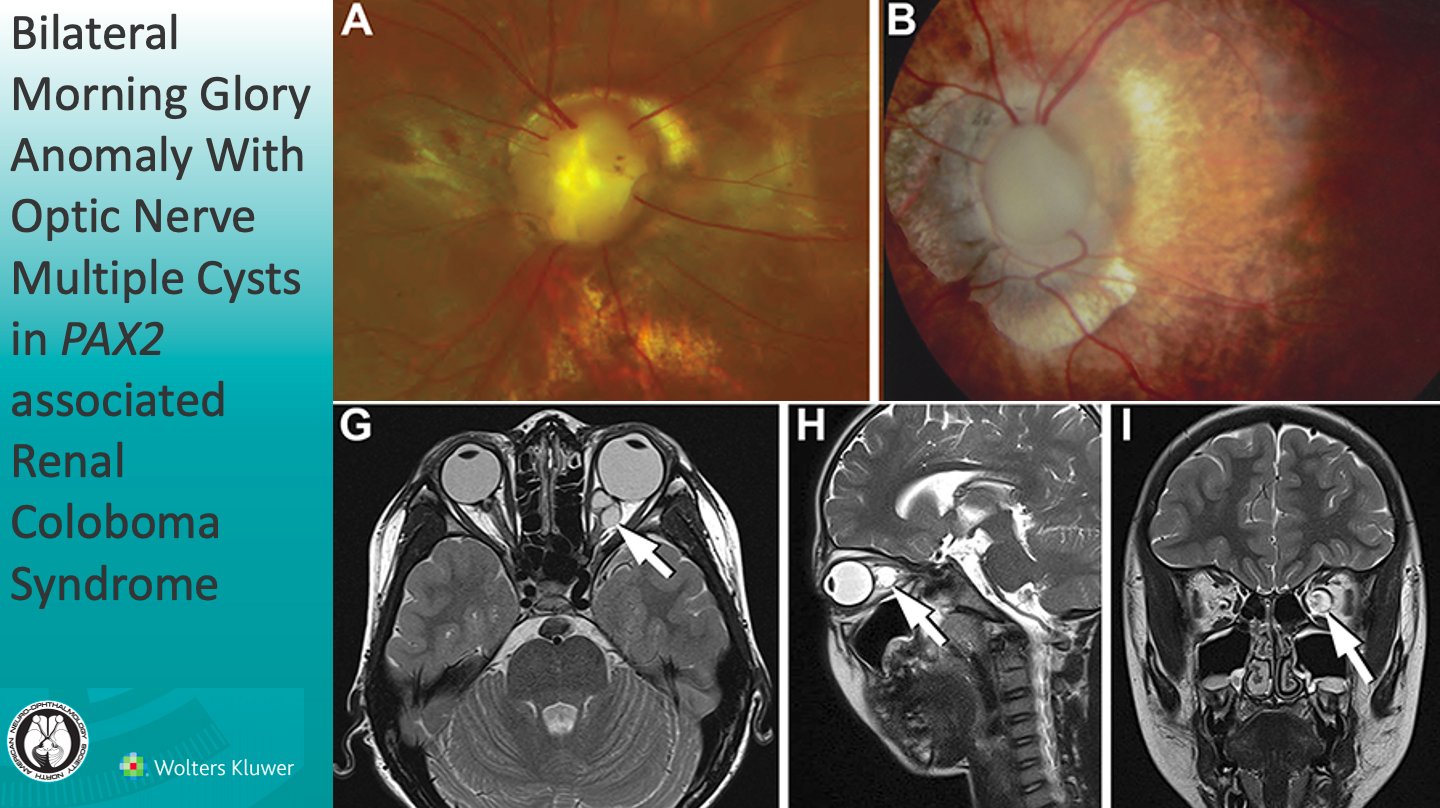 Coloboma Mri